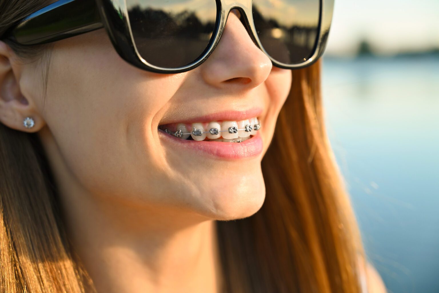 Traditional Braces: A Comprehensive Guide