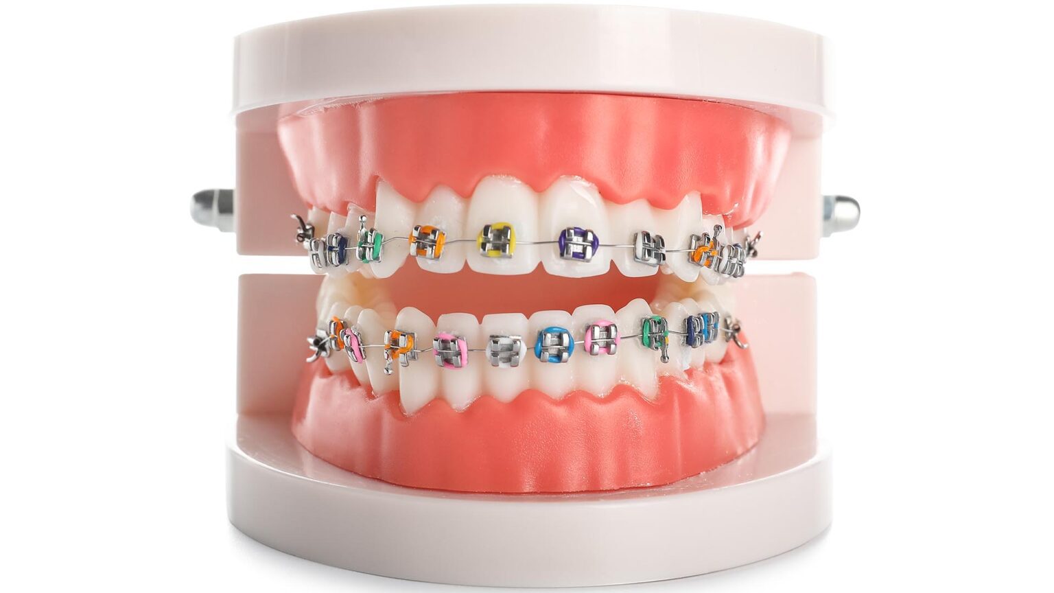What Braces Colors are Available? | Coastline Orthodontics